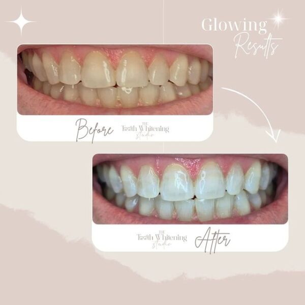 Treatments – The Tooth Whitening Studio