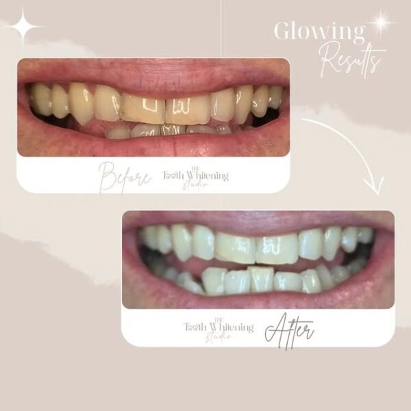 Luminating LED Kit – The Tooth Whitening Studio