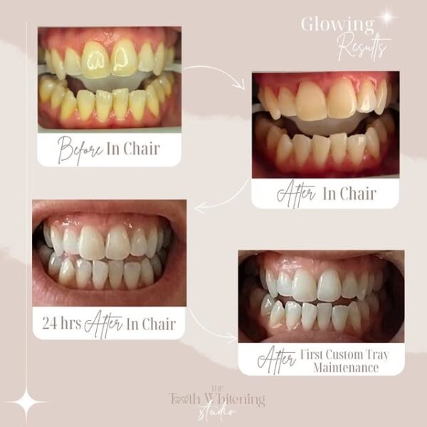 Treatments – The Tooth Whitening Studio